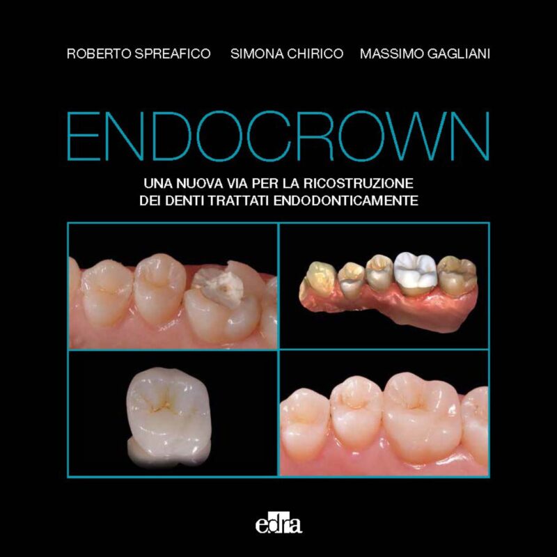 ENDOCROWN Una nuova via per la ricostruzione dei denti trattati ...